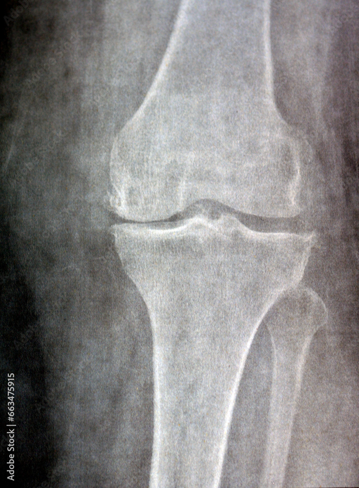 Stock-Foto „Plain X ray of the left knee shows apparent joint ...