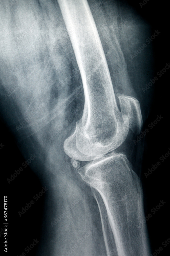 Plain X ray of the left knee shows apparent joint osteoarthritis ...