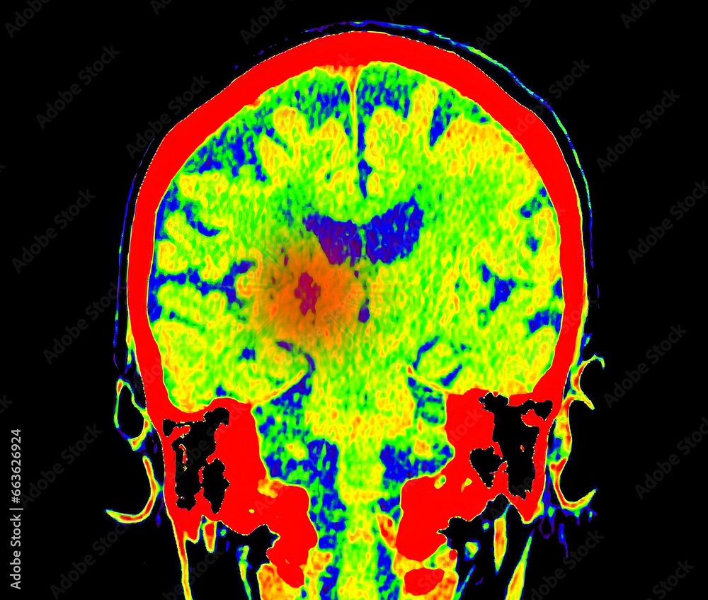 CT Brain Perfusion or CT scan image of the brain axial view showing ...