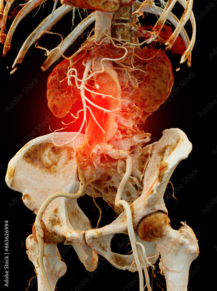 CTA abdominal aorta showing abdomenal aortic dissection 3D rendering ...