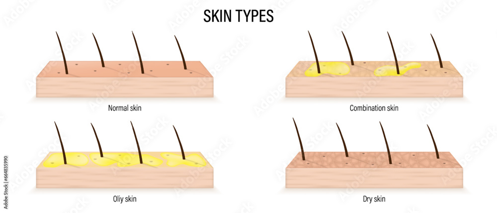 Skin types vector. Different types of skin problems. Normal ...