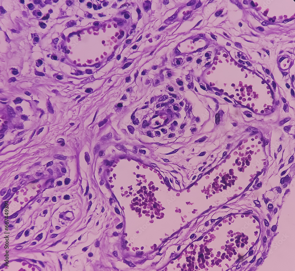 Synovial Tissue Biopsy Villonodular Synovitis Ganglion Cells Smear Show Papillary Villous
