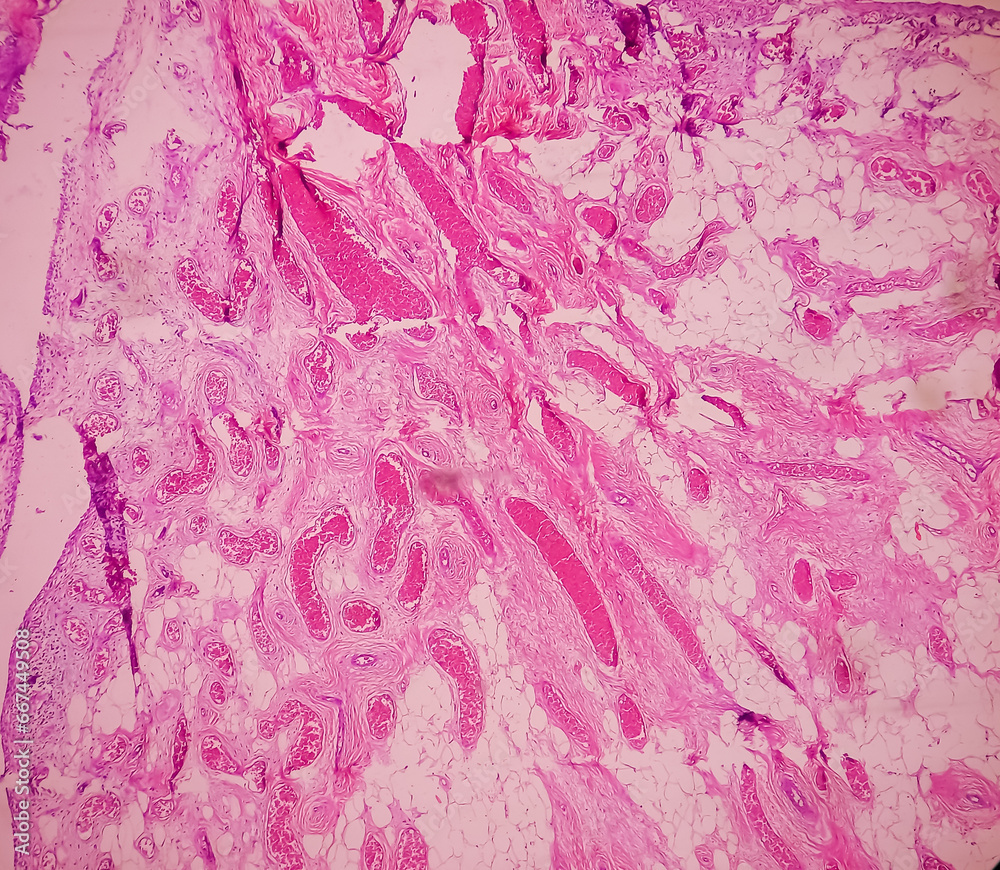 Microscopic image of Synovial tissue of knee joint. Baker's cyst ...