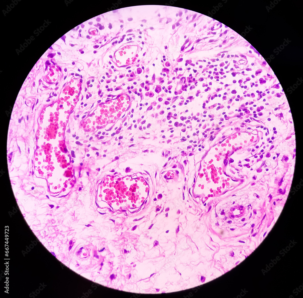 Microscopic image of Synovial tissue of knee joint. Baker's cyst ...