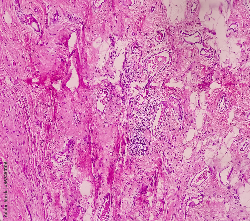 Microscopic image of Synovial tissue of knee joint. Baker's cyst ...