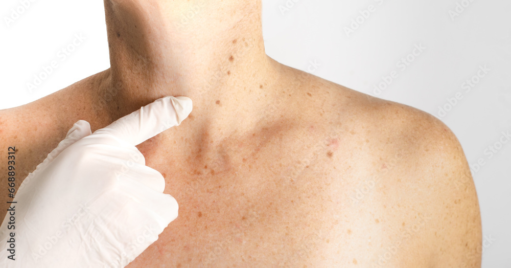 Doctor with white gloves pointing at white woman, nevus, moles, spots ...