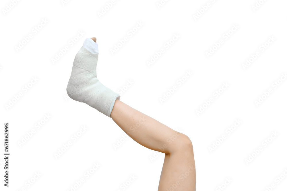Fractured foot in a plaster cast on a white background. White plaster ...