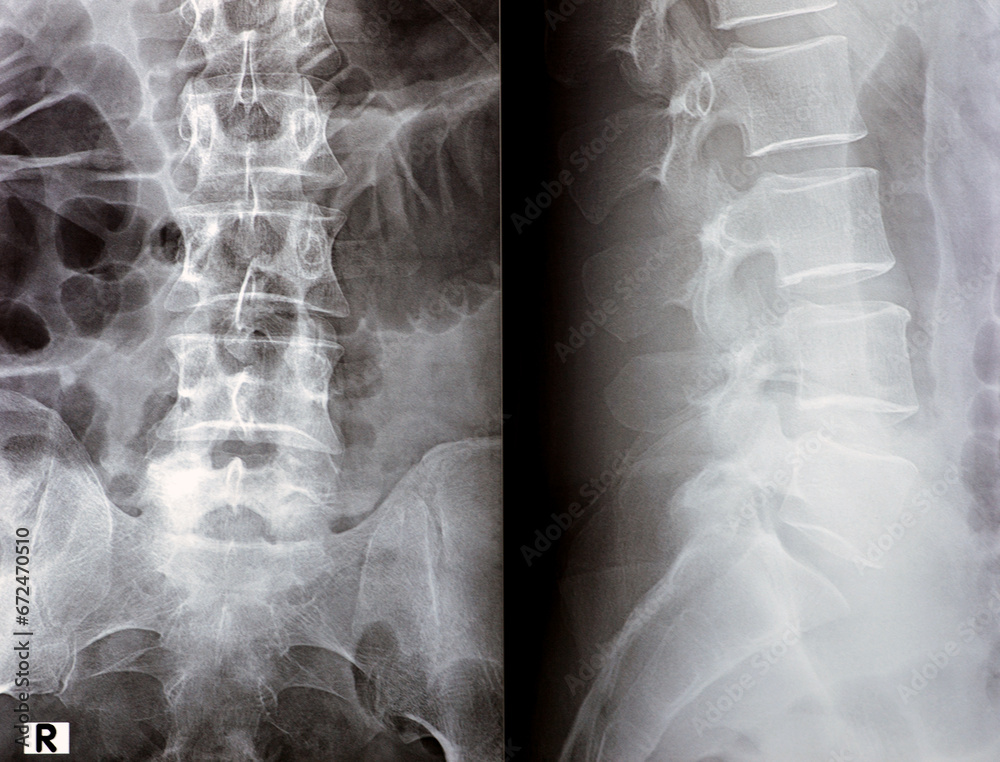 Lumbosacral spine digital radiographic examination reveals straightened ...