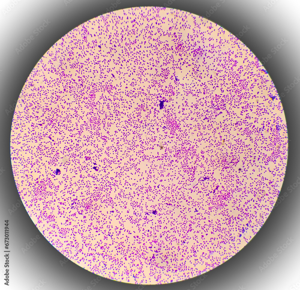 Bacterial colonies gram stained microscopic show Staphylococcus aureus ...
