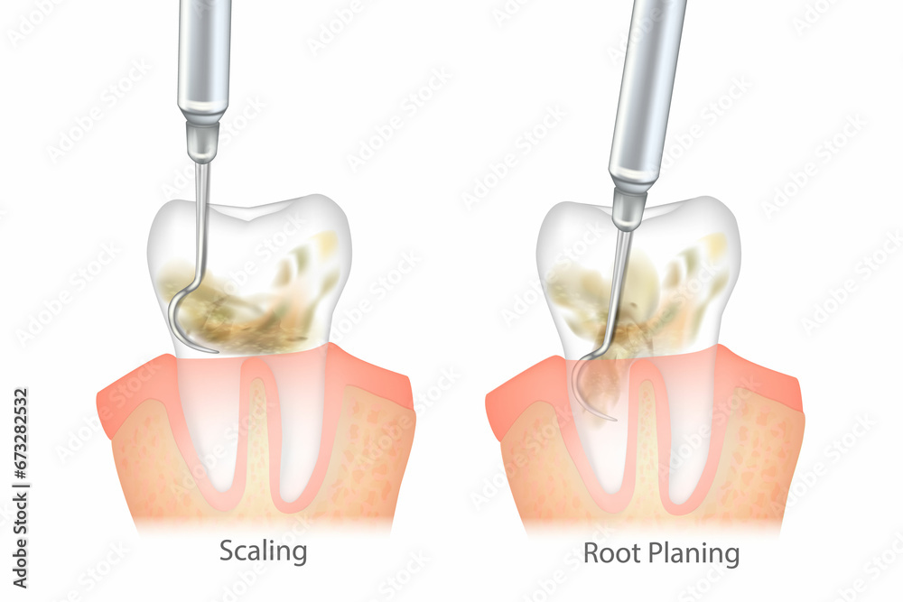 Difference of the Periodontal Scaling and Root Planing. Oral hygiene ...