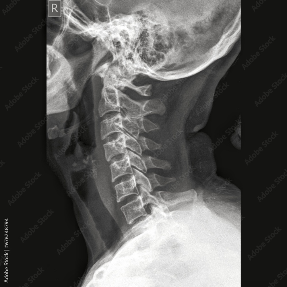 x ray of a human cervical spine lateral view (neck lateral x-ray image) Stock Photo | Adobe Stock