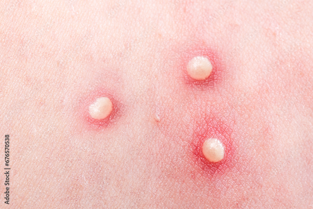 Foto de Stock Pimple, acne or comedones. Inflamed pimples, pustules ...