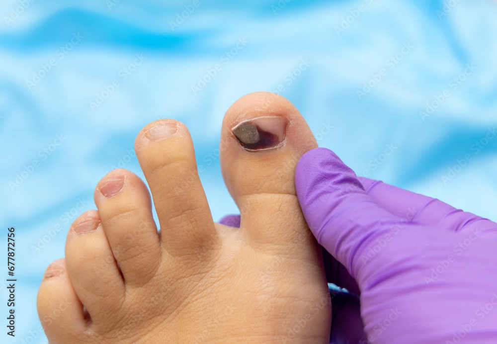 hematoma wound on runner's toe nail. consequences of wearing ...