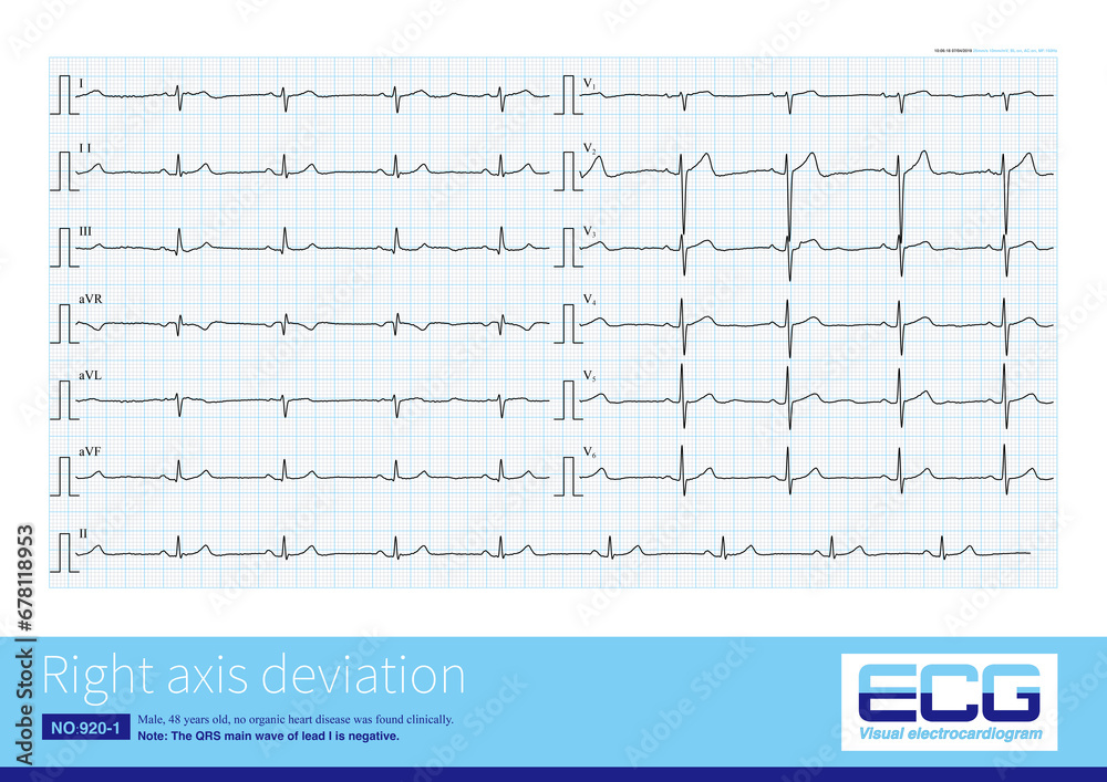 Right axis deviation can be seen both in right ventricular hypertrophy ...