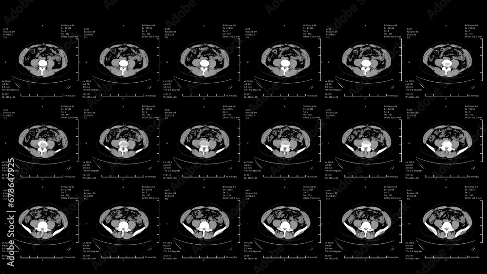 CT scan. 3 to 6 MRI x ray Scan.Medical HUD Analyzing abdominal ...