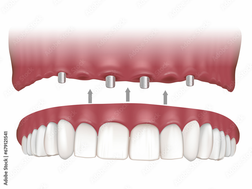 Maxillary Implant Supported Fixed Prosthesis. Maxillary overdentures ...