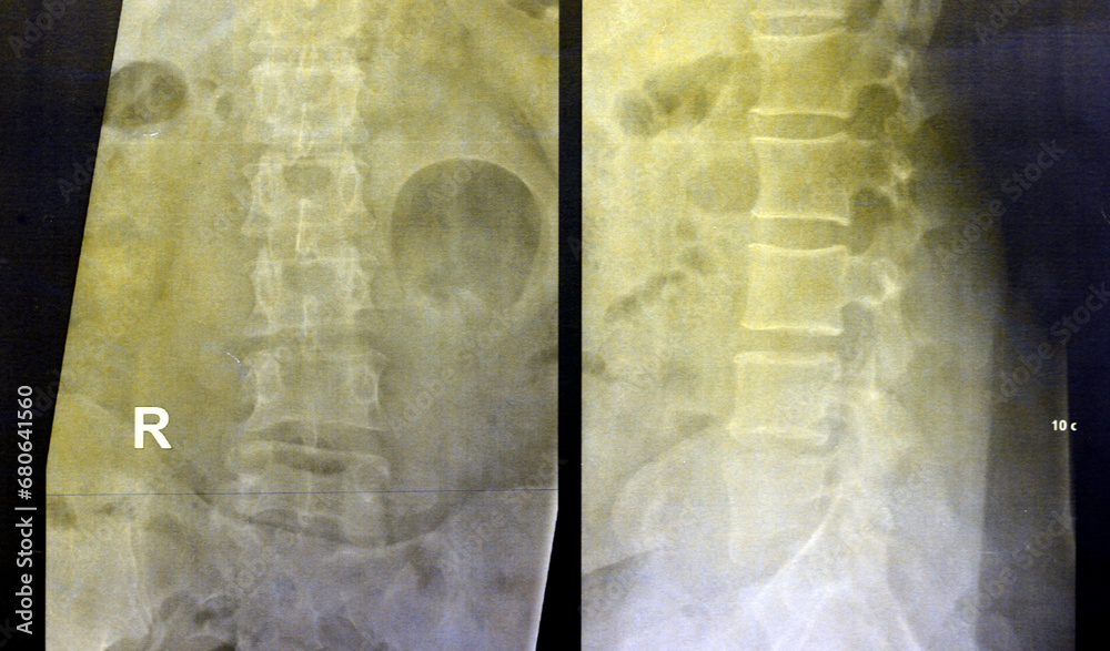 Plain X ray lumbosacral spine revealed straightened, mild scoliotic ...