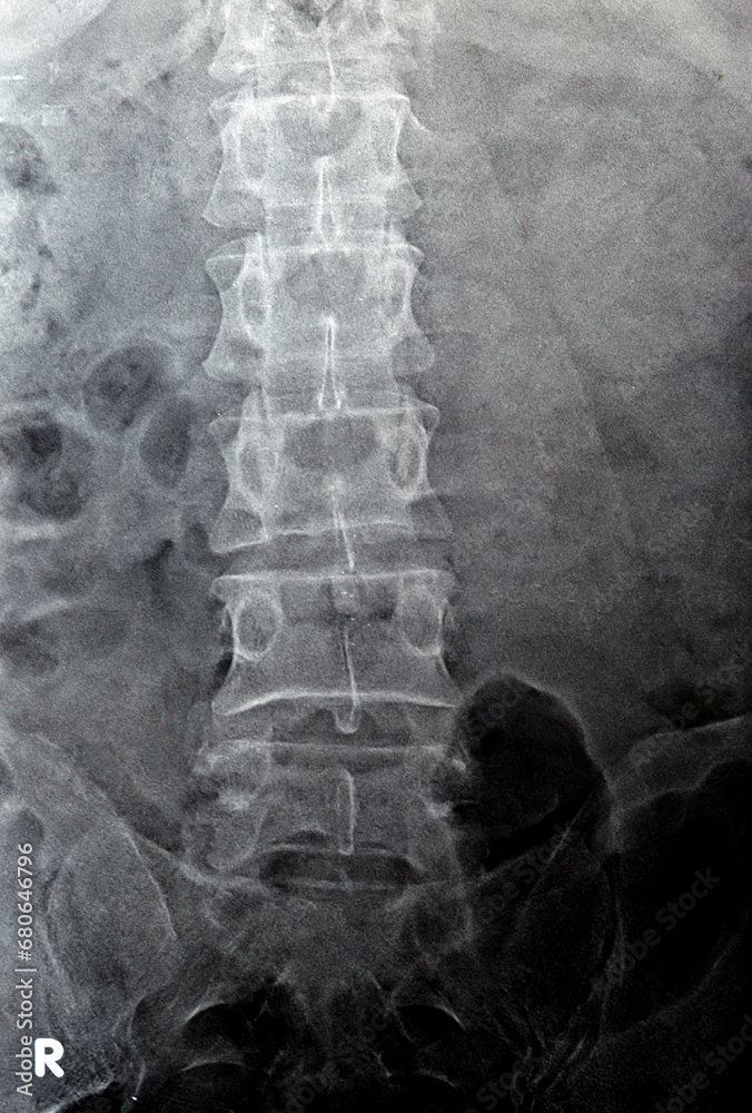 Plain X ray lumbosacral spine revealed straightened, mild scoliotic ...