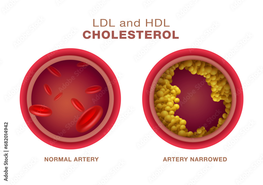 Stock-Vektorgrafik „Types of comparison of atherosclerotic cholesterol ...