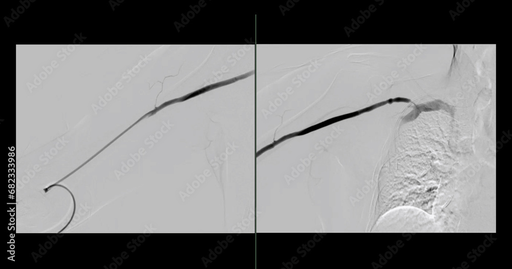 Balloon Angioplasty is a medical procedure used to widen narrowed or ...