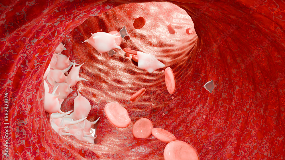 Hemostasis. Red blood cells and platelets in the blood vessel ...