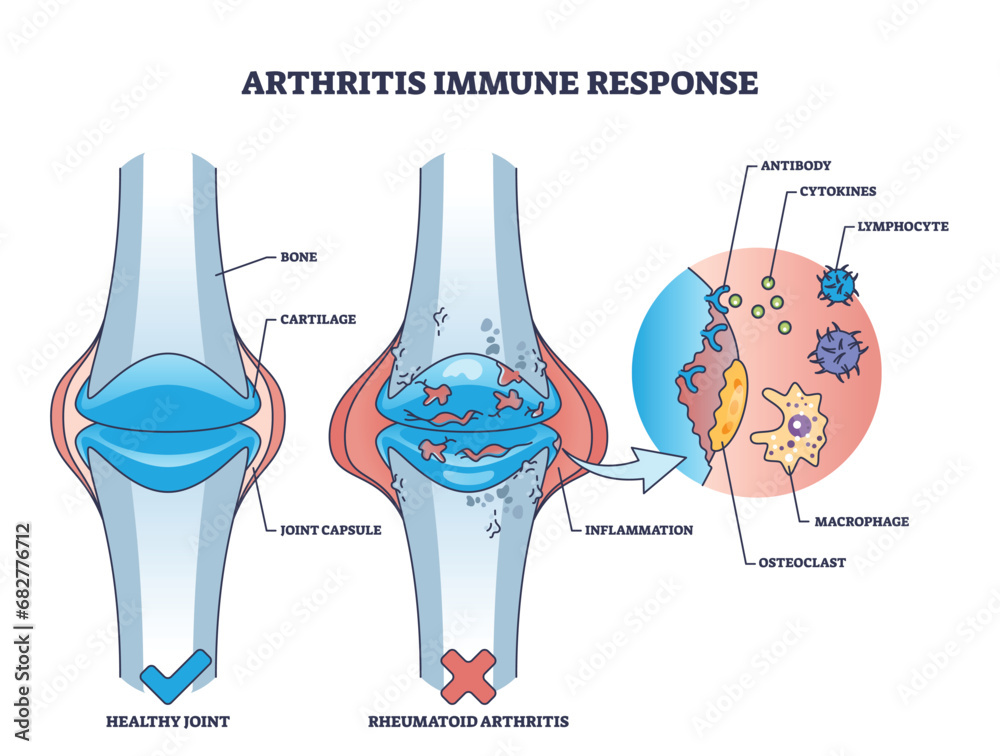 Arthritis immune response with rheumatoid bone disease outline diagram. Labeled educational ...