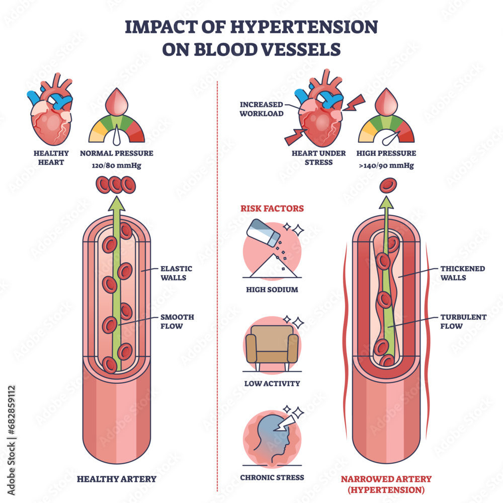 Impact of hypertension on blood vessels with high pressure outline ...