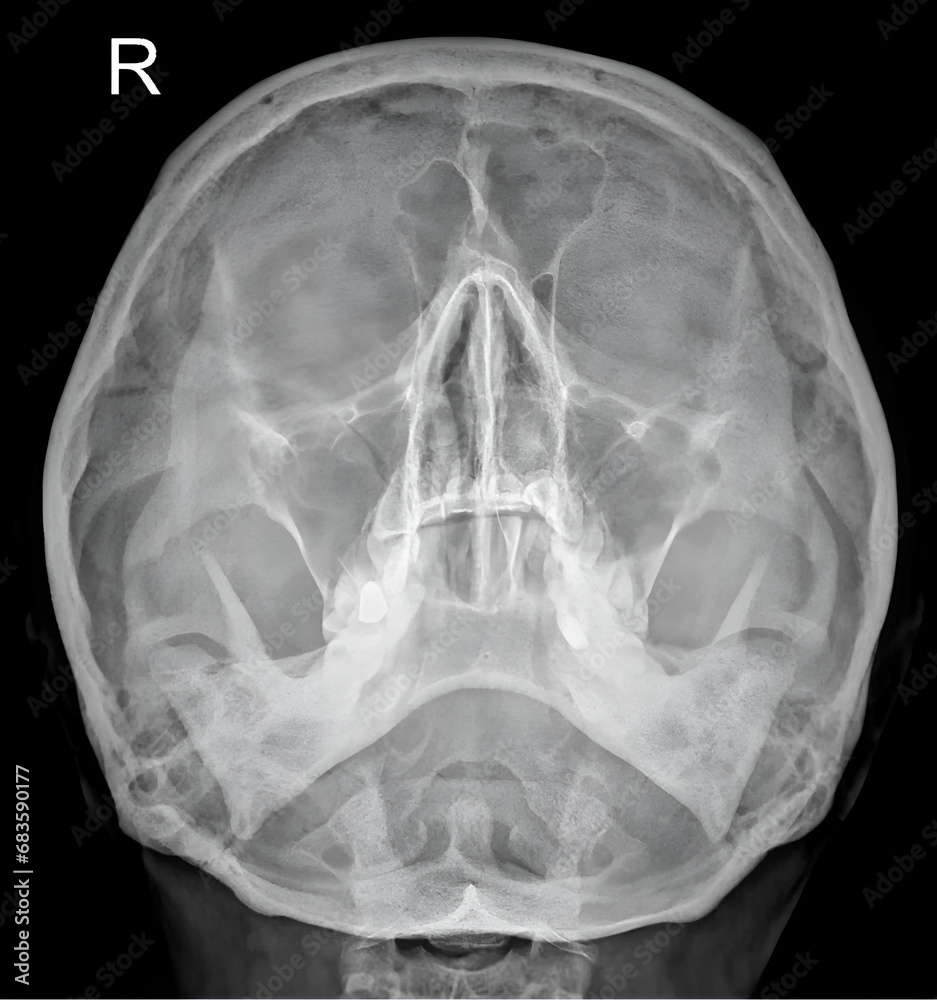 Foto de Stock Sinus X-ray depicting the paranasal sinuses, including ...