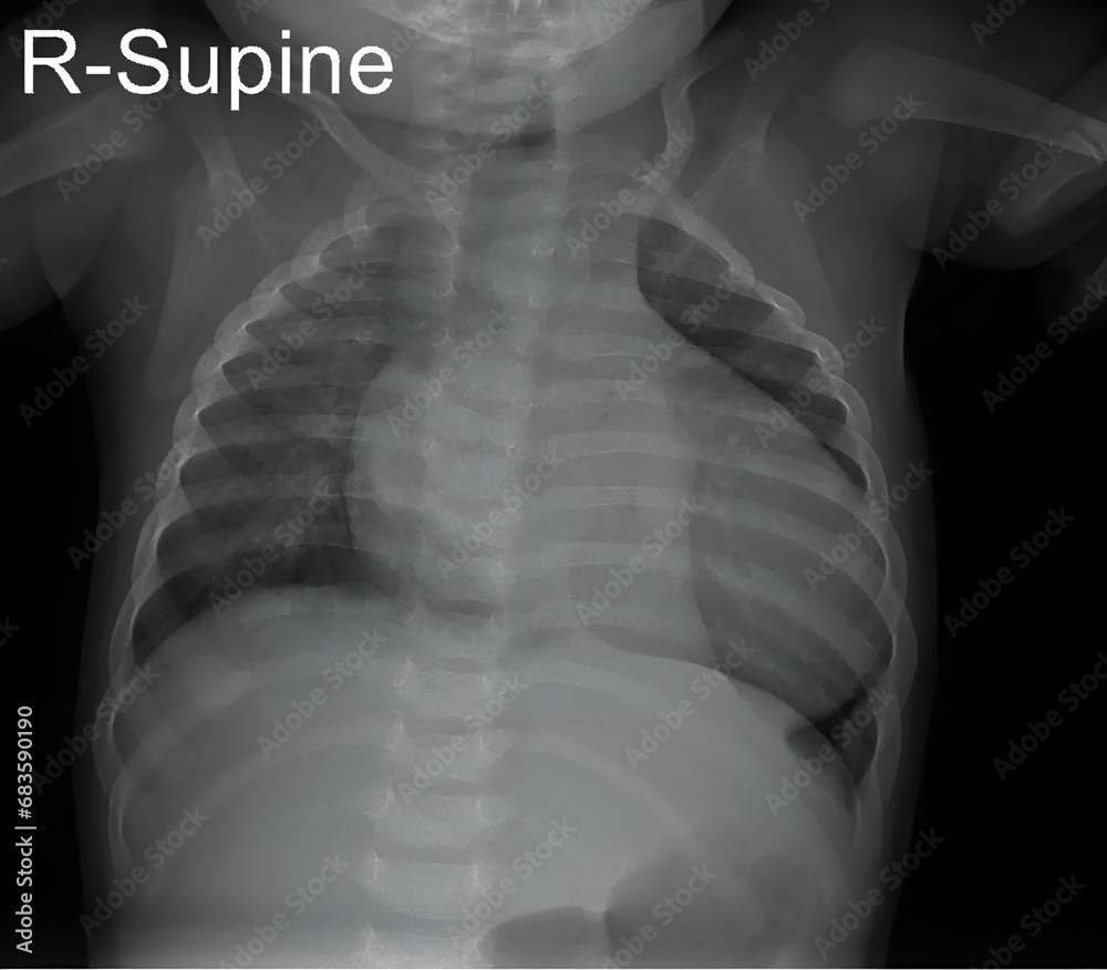 Pediatric chest X-ray revealing the thoracic anatomy of a child Stock ...