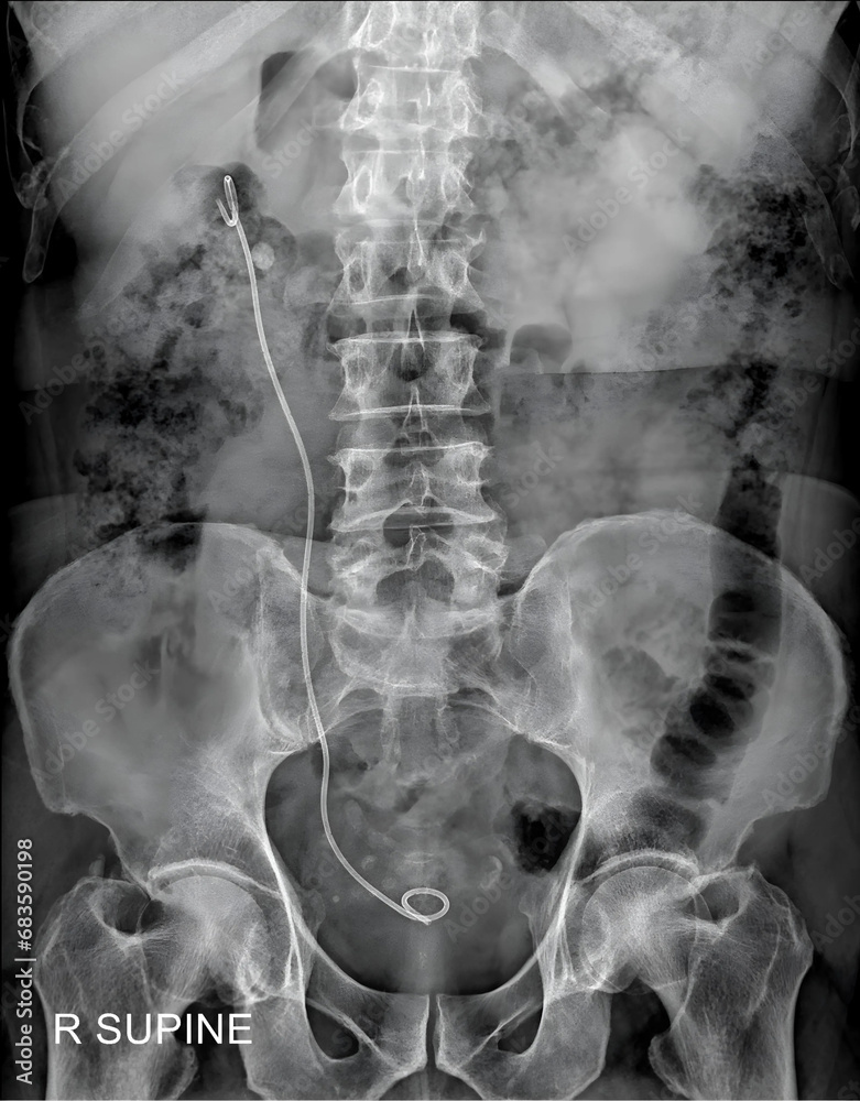 Stock-Foto „ X-ray KUB Imaging: Radiographic Evaluation of Ureteral JJ ...