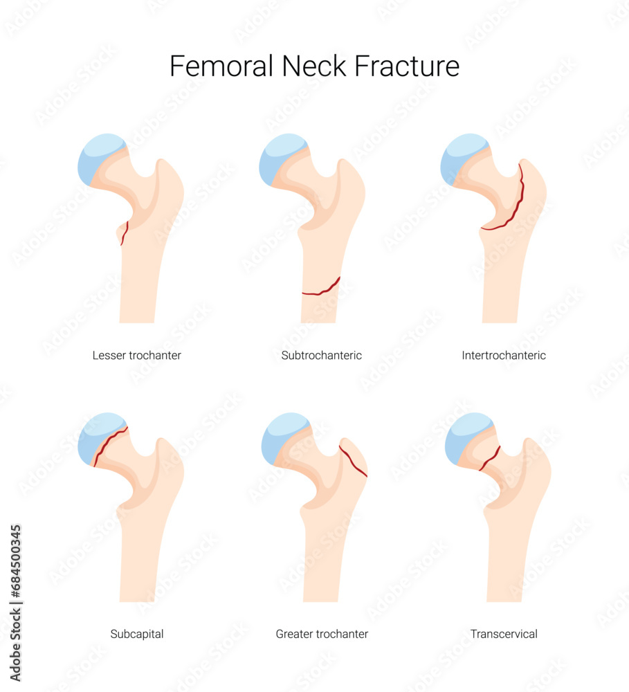 Types of Femoral Neck Fracture Disease Stock Vector | Adobe Stock