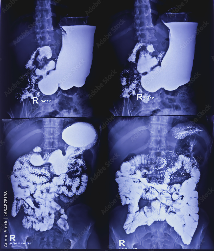Barium swallow of oesophagus examination x-ray. showing upper digestive ...