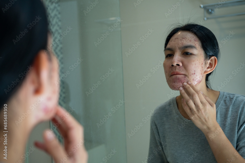 Acne on face because the disorders of sebaceous glands productions ...