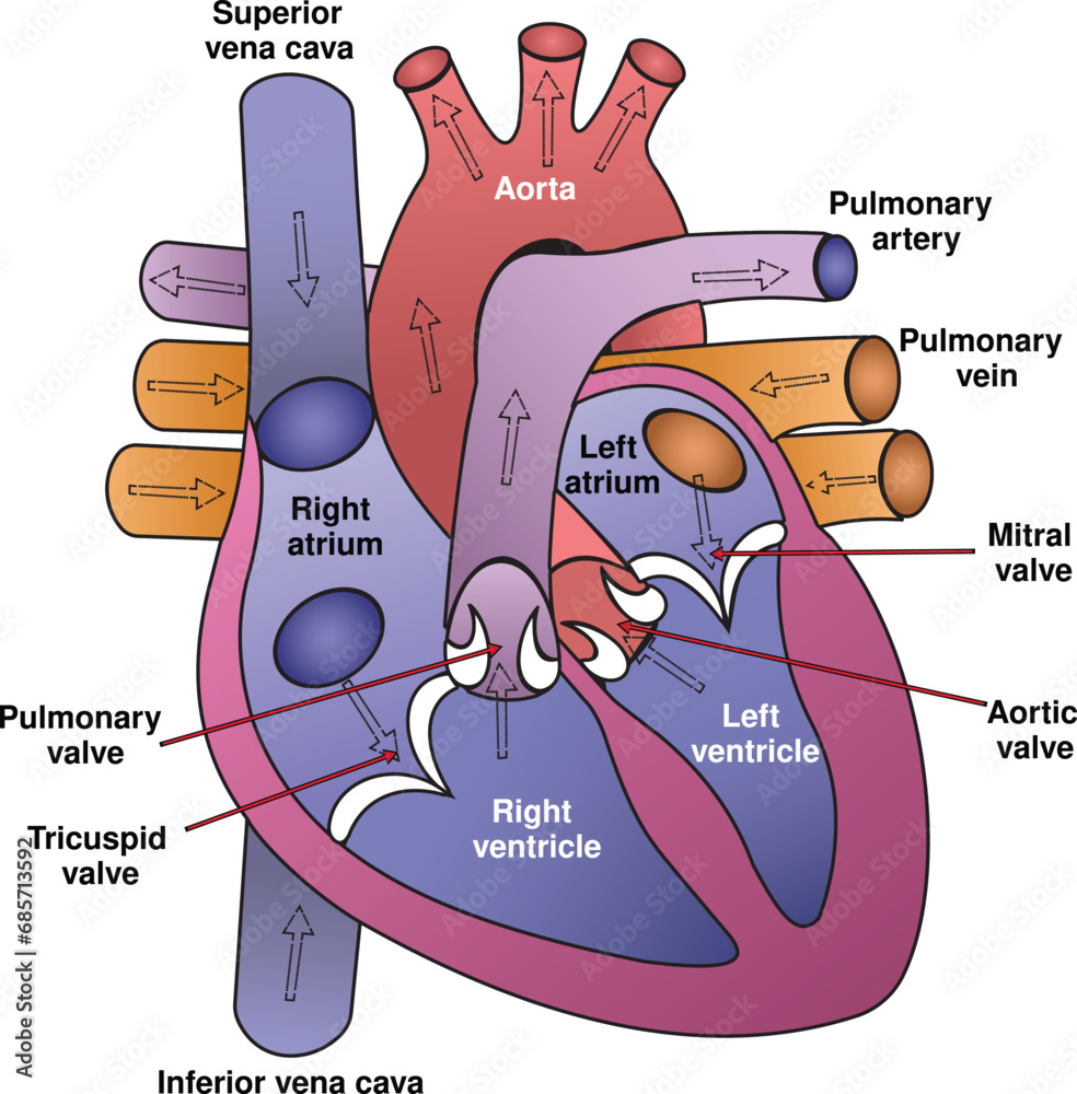 vector Human heart diagram, Heart showing Ebstein's anomaly, with ...