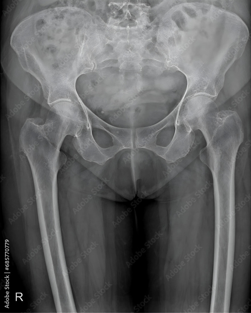 X-ray image of the female pelvis with proximal femurs Stock Photo ...