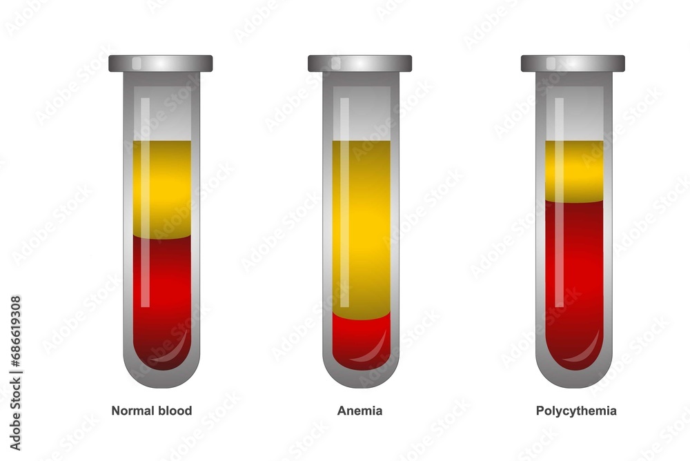 Blood inside a test tube with different concentrations of Hematocrit ...
