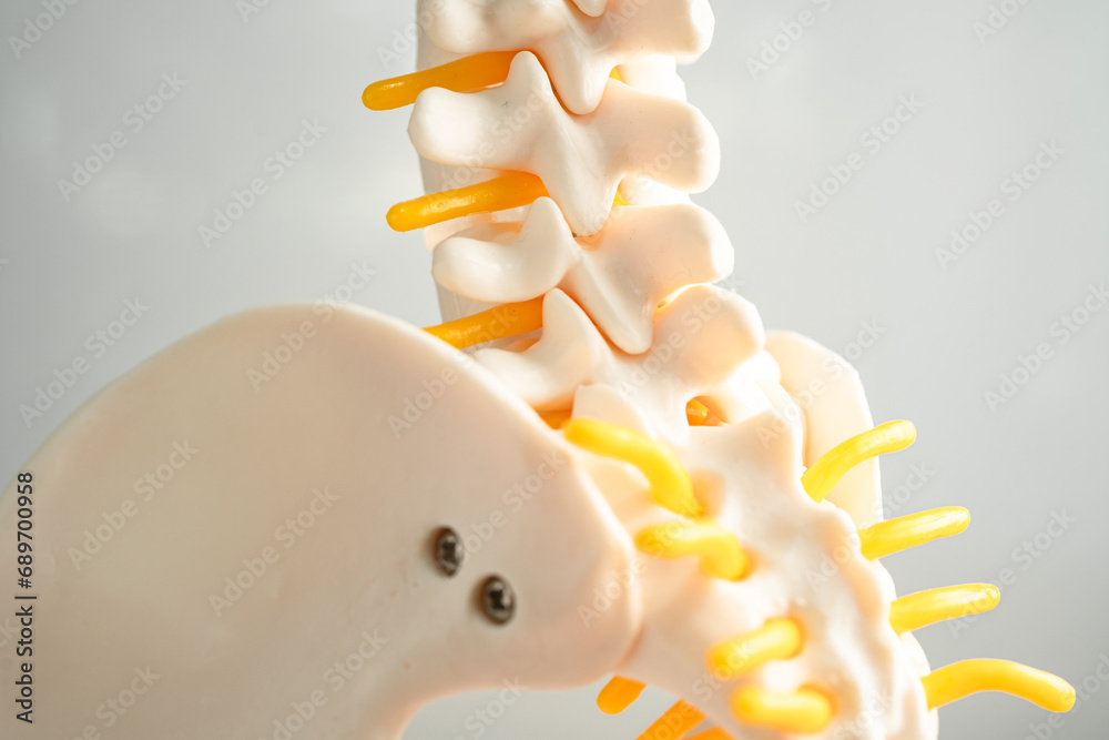 Lumbar spine displaced herniated disc fragment, spinal nerve and bone ...
