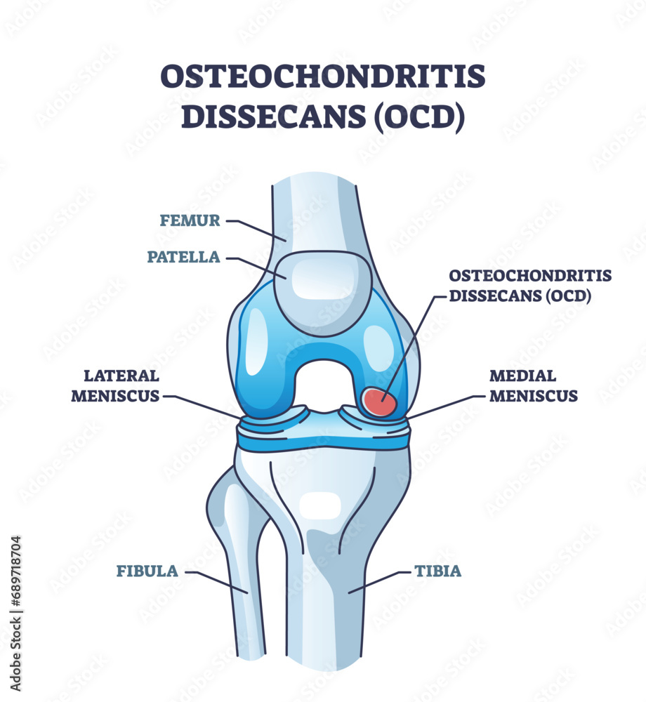 Vektor Osteochondritis dissecans or OCD bone and cartilage condition ...