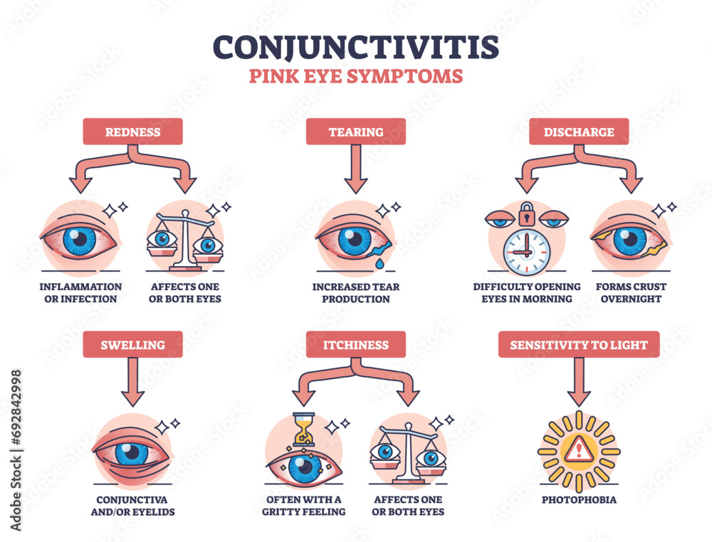 Conjunctivitis or pink eye symptoms with medical examples outline ...