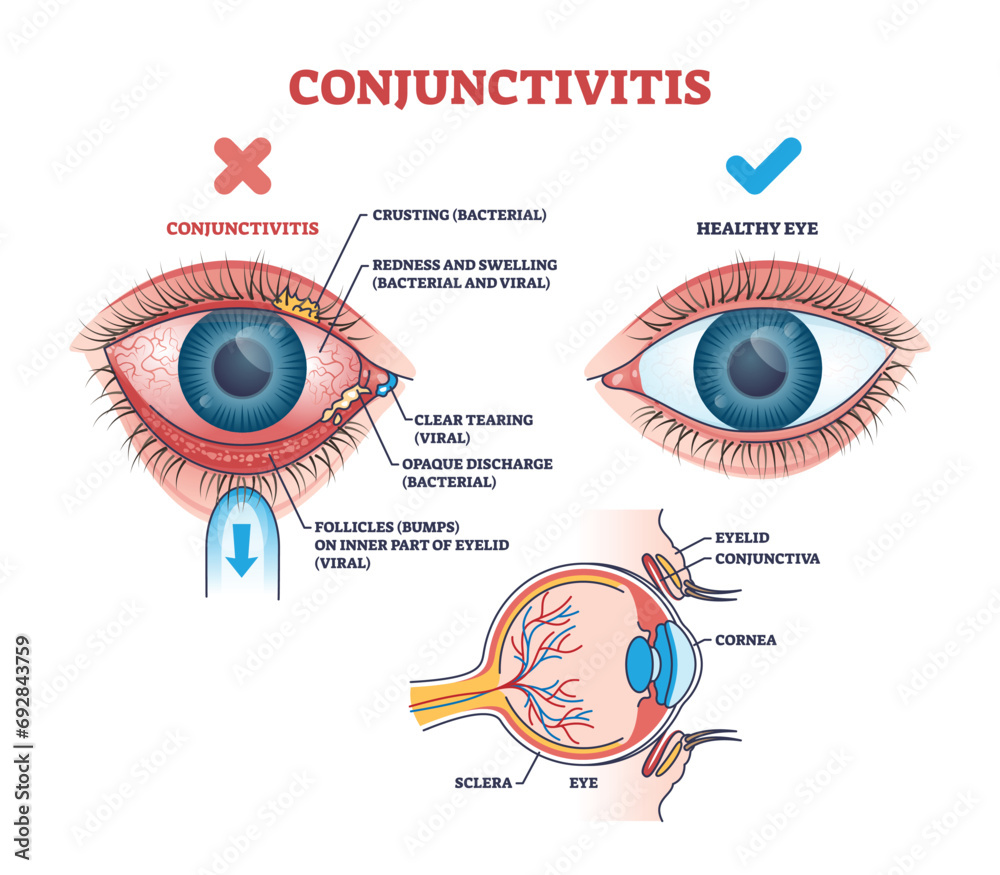 Conjunctivitis pink eye medical condition explanation outline diagram ...