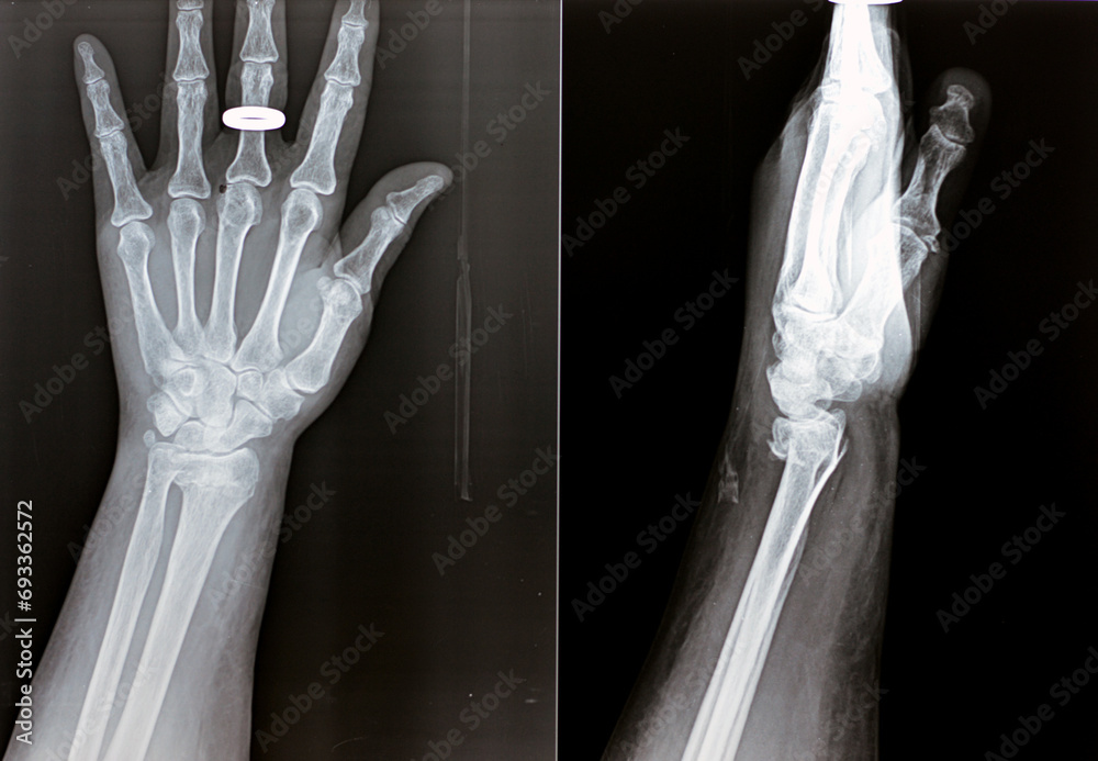 Colles' fracture of an old female, a type of fracture of the distal ...