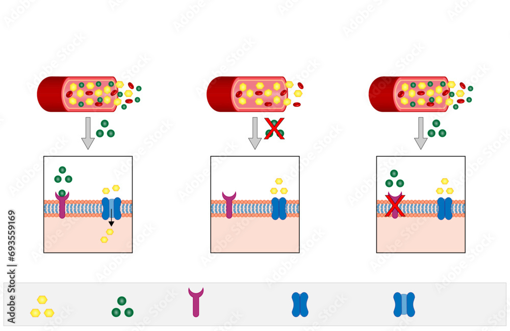 Diabetes mellitus type 1, pancreas's failure to produce enough insulin ...
