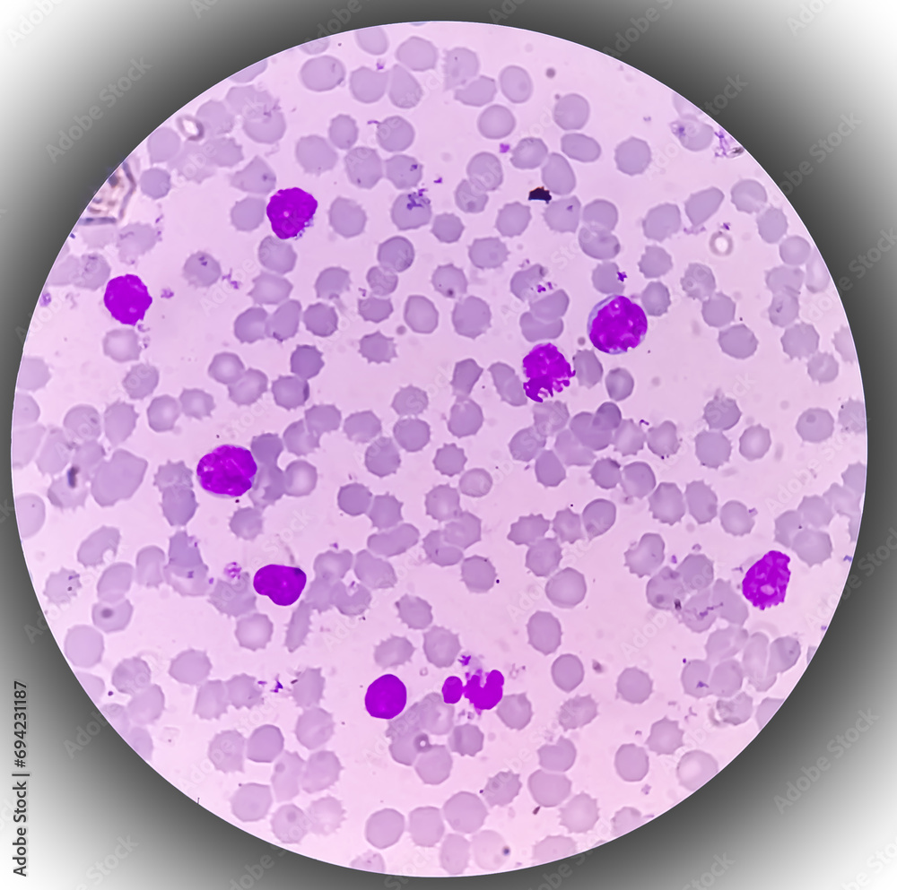 Leukemia. blood cells, blast cells and immature leukocytic cells in ...