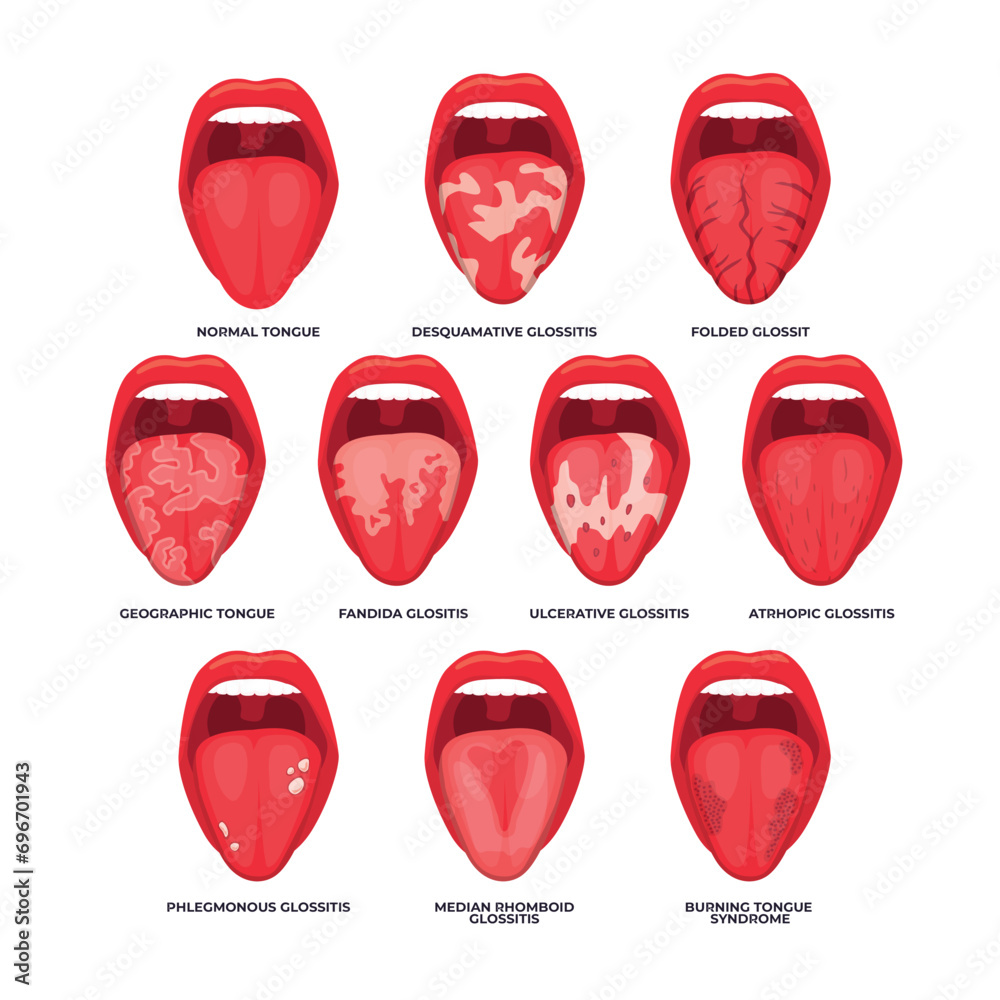 Set of different types of glossitis collection, Diagram of tongue ...