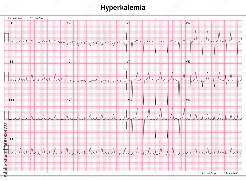ECG Hyperkalemia - Hyperkalaemia - 12 Lead ECG Common Case - 3 Sec/lead ...