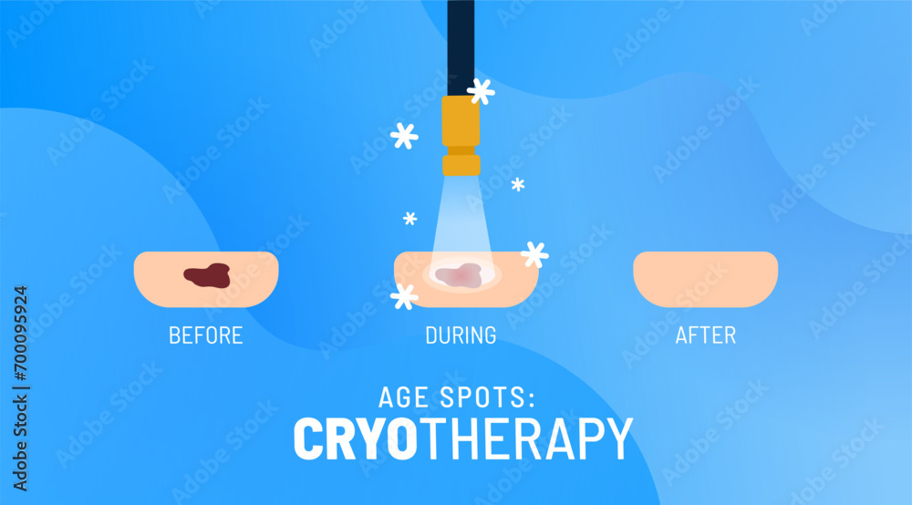 Cryotherapy process vector illustration. Removing age spots on skin ...