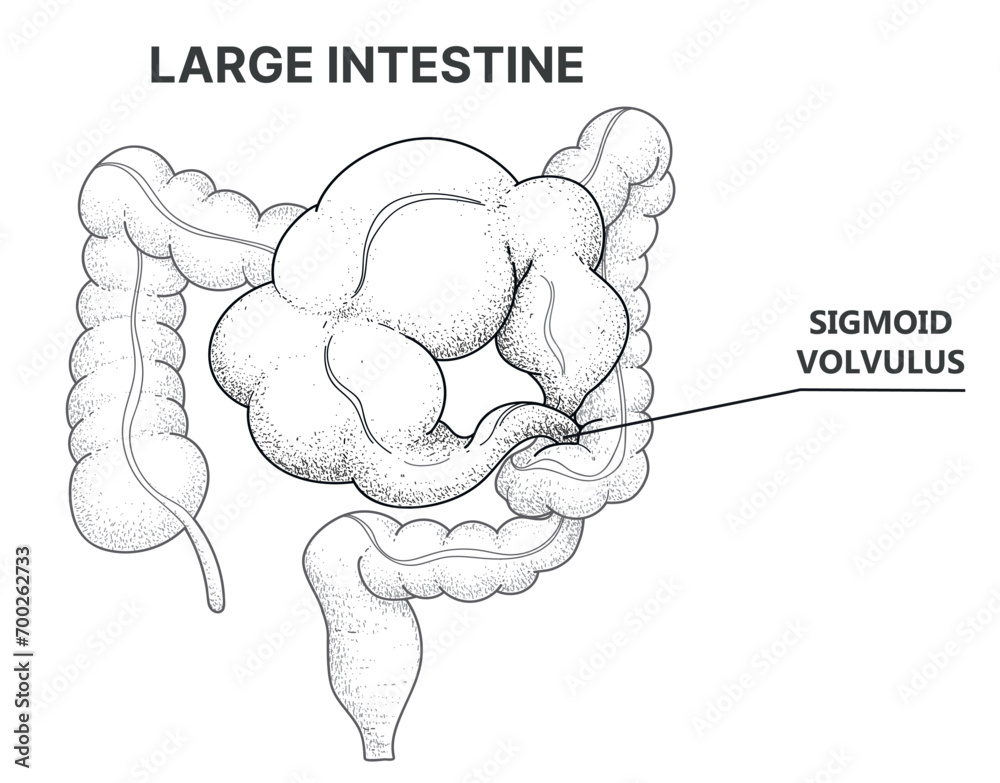 Bowel obstruction. Sigmoid volvulus. Line art drawing. Healthcare ...