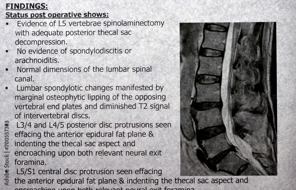 Foto de Stock MRI lumbosacral spine shows L5 Vertebrae Spinal ... Foto de Stock MRI lumbosacral spine shows L5 Vertebrae Spinal ...