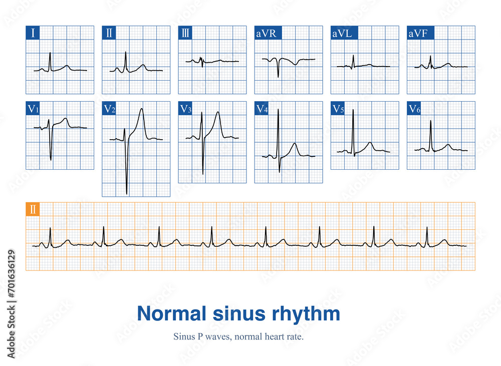 Male 36 Years Old In Good Health Outpatient Physical Examination Ecg The Ecg Is Sinus Rhythm