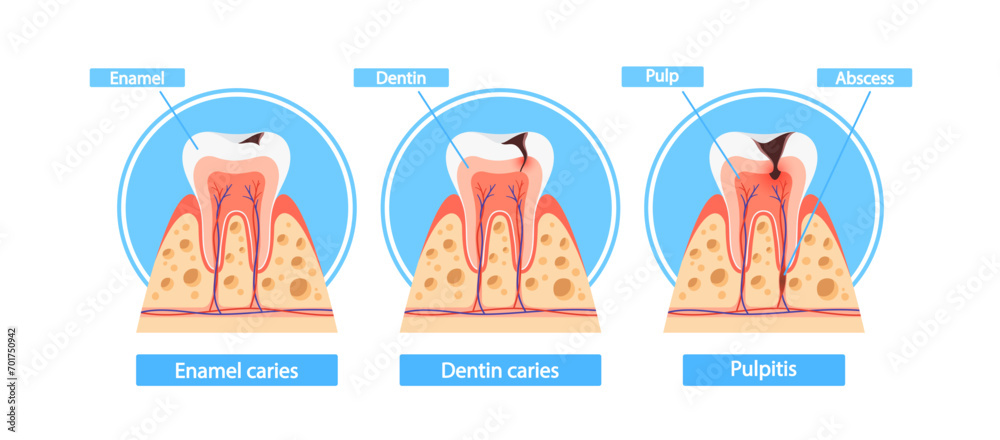 Stages Of Caries Infographics. Enamel Caries, Dentin Caries, And ...